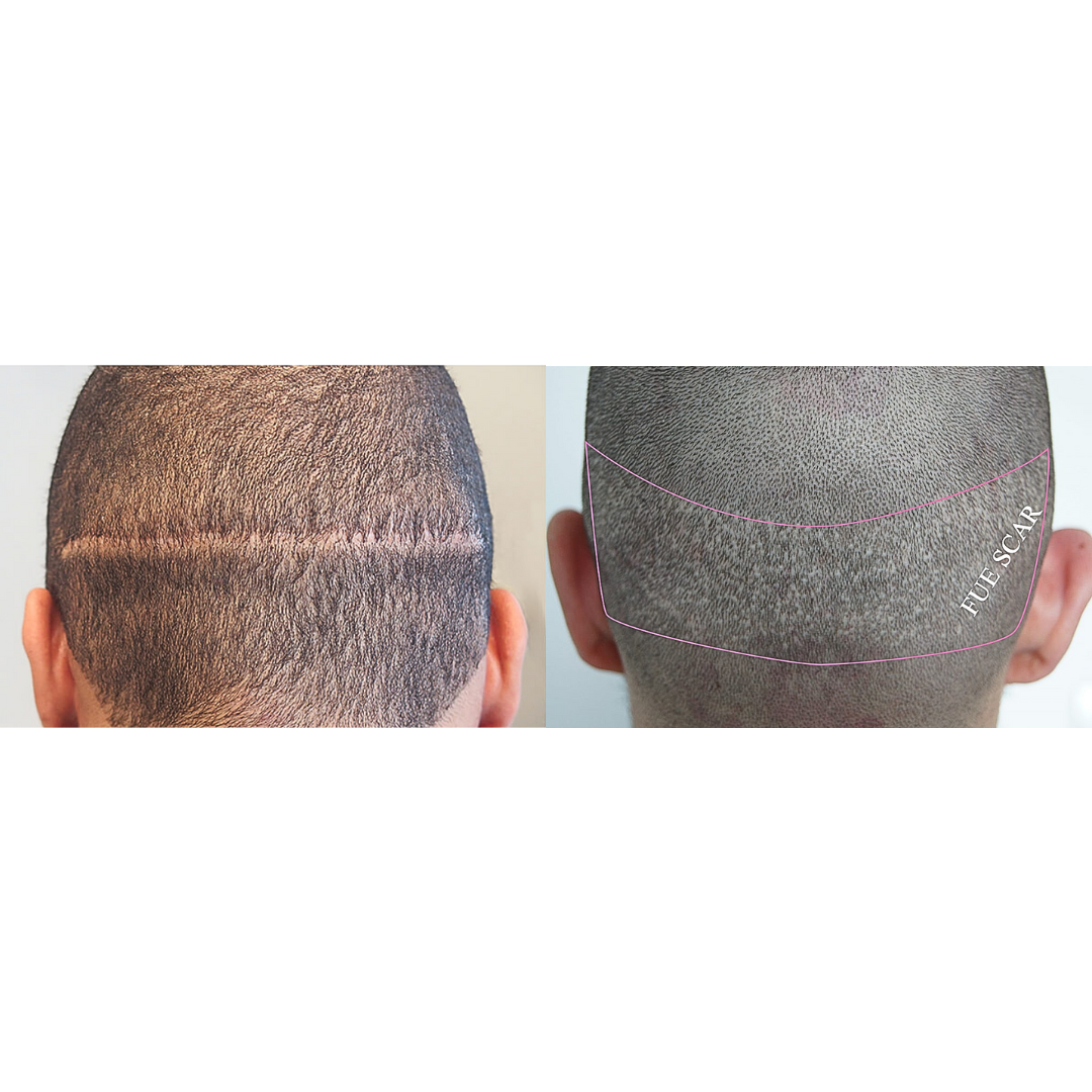 Scalp Micropigmentation for Camouflaging Hair Transplant Scars: The ...