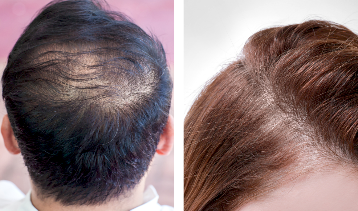 Scalp micropigmentation for thinning hair: Sick of Thinning Hair? Scalp ...