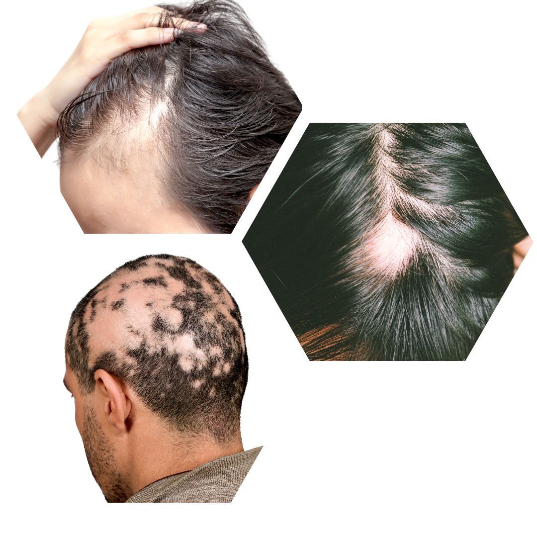 Scalp Micropigmentation for Alopecia: The Secret to Beating Alopecia ...